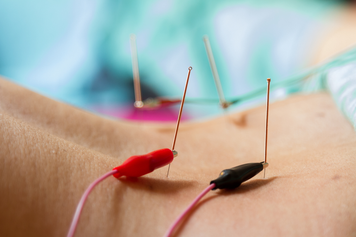 Electro-Acupuncture: What It Is & How It Works