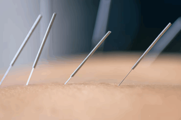 How Deep Do Acupuncture Needles Go A Safe Start